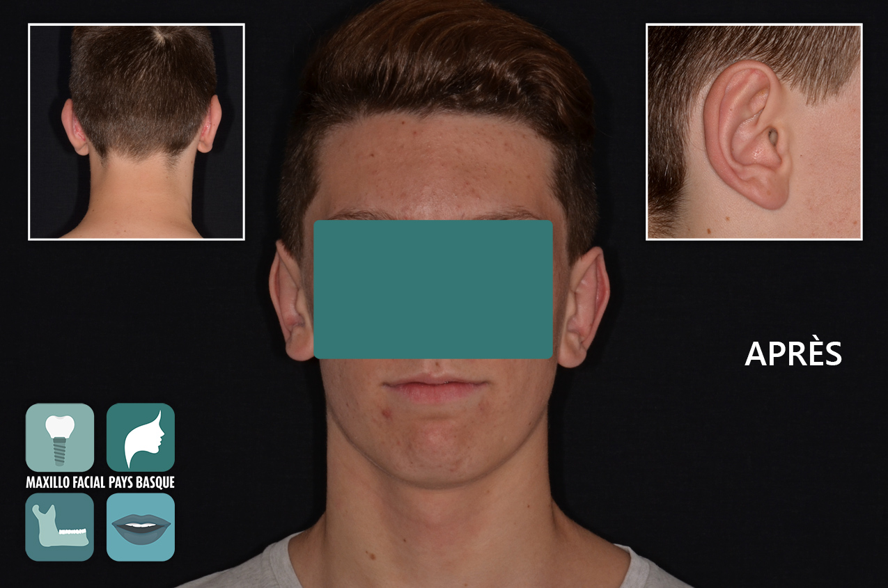 Chirurgie des oreilles décollées (Otoplastie) à Bayonne