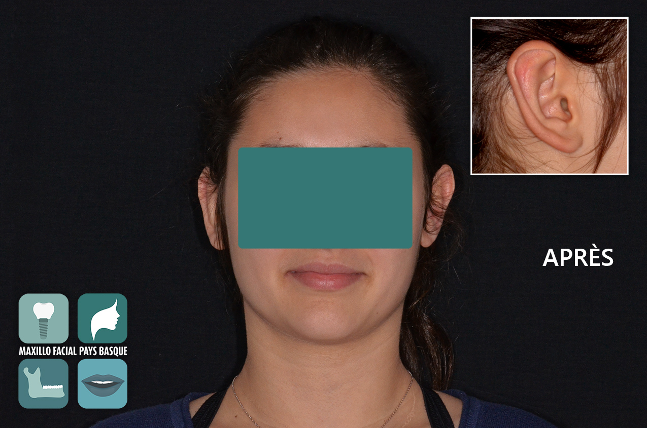 Chirurgie des oreilles décollées (Otoplastie) à Bayonne